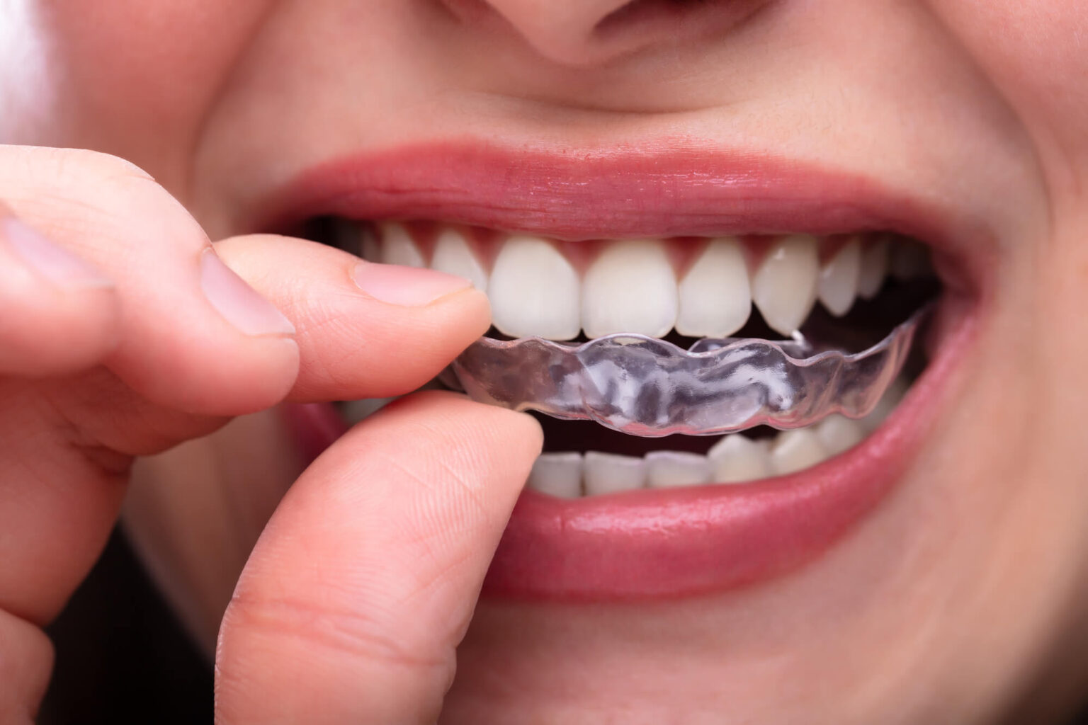 What To Know About Invisalign - My Zeo