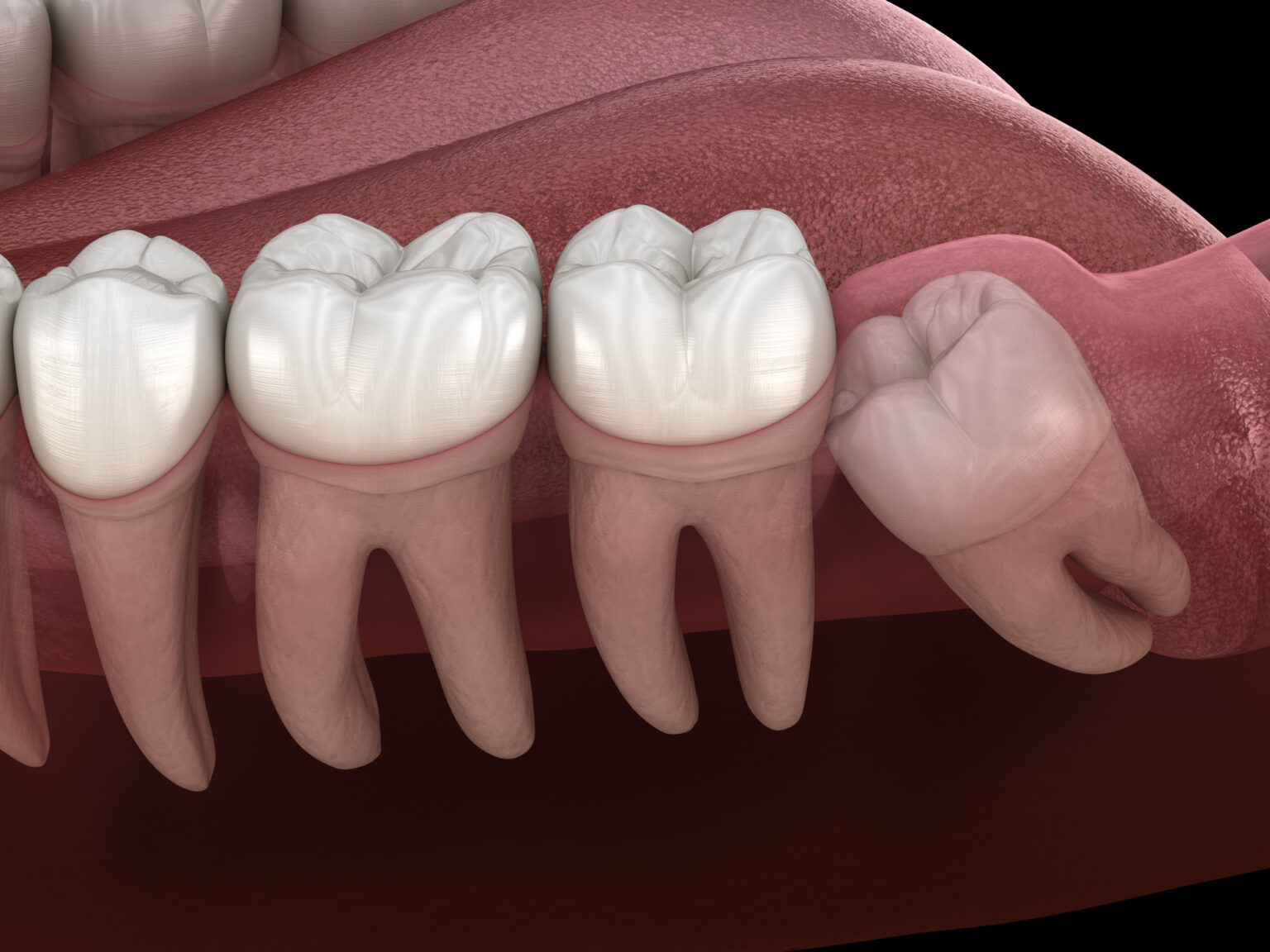 What Is an Impacted Tooth? Causes, Symptoms, and Treatment - My Zeo