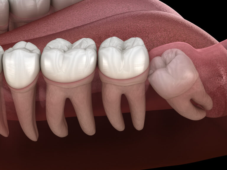What Is an Impacted Tooth? Causes, Symptoms, and Treatment - My Zeo